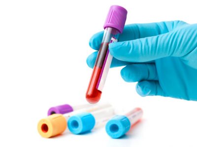 What blood tests are used to determine your testosterone levels?
