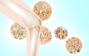 What Is the Link Between Testosterone, Osteoporosis, and Bone Health?